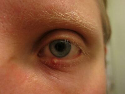 Hordeolum (Stye) | Concise Medical Knowledge