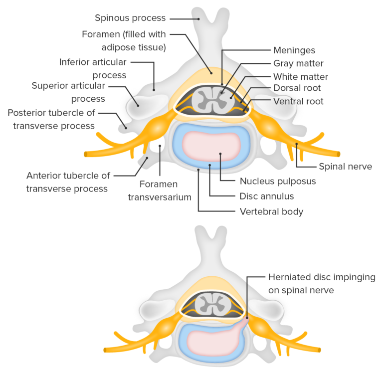 Spinal Disk Herniation | Concise Medical Knowledge