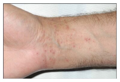 Generalized and Localized Rashes | Concise Medical Knowledge