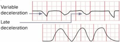 Electronic Fetal Monitoring [+ Free Cheat Sheet] | Lecturio