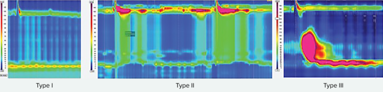 Acalasia | Concise Medical Knowledge