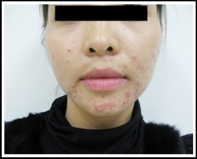 Acné Vulgar | Concise Medical Knowledge