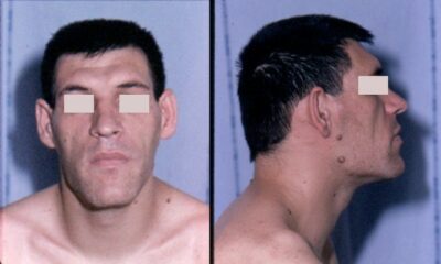 Acromegaly and Gigantism | Concise Medical Knowledge