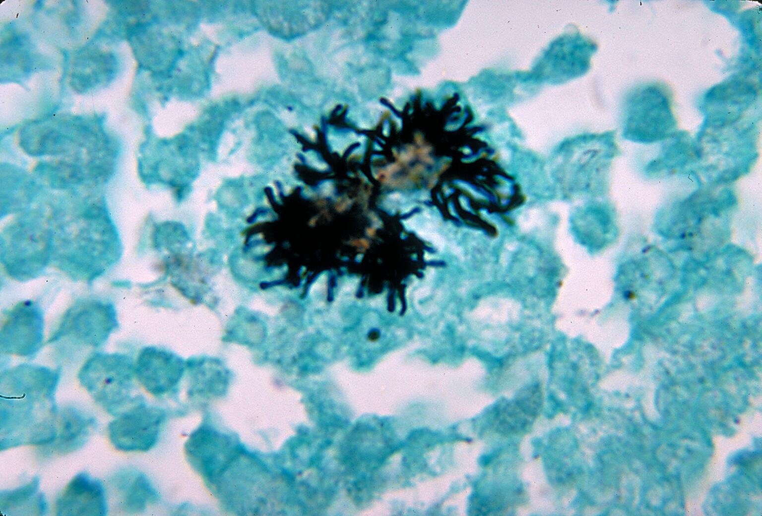 Actinomyces/Actinomycosis | Concise Medical Knowledge