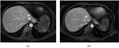 Budd-Chiari Syndrome | Concise Medical Knowledge