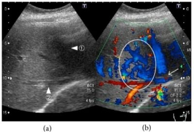 Budd-Chiari Syndrome | Concise Medical Knowledge