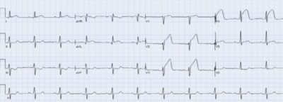 Coronary Heart Disease | Concise Medical Knowledge