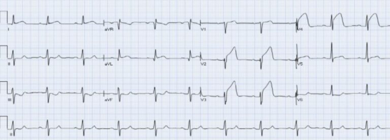 Coronary Heart Disease | Concise Medical Knowledge Coronary Heart Disease | Concise Medical Knowledge