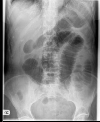 Small Bowel Obstruction | Concise Medical Knowledge