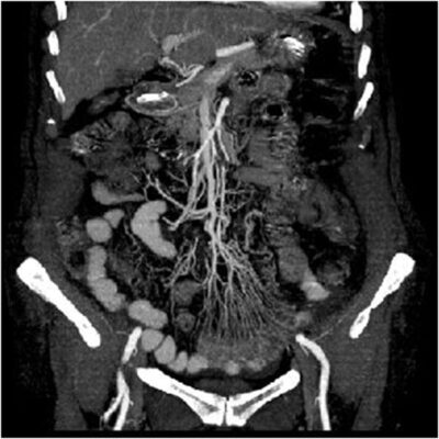 Intestinal Ischemia | Concise Medical Knowledge
