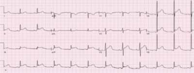 Pericarditis | Concise Medical Knowledge