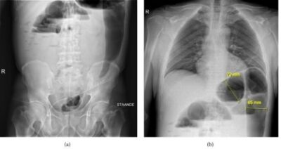 Megacolon | Concise Medical Knowledge