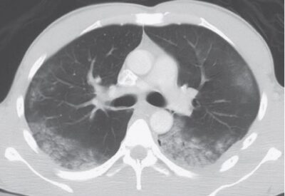 Imaging of the Lungs and Pleura | Concise Medical Knowledge