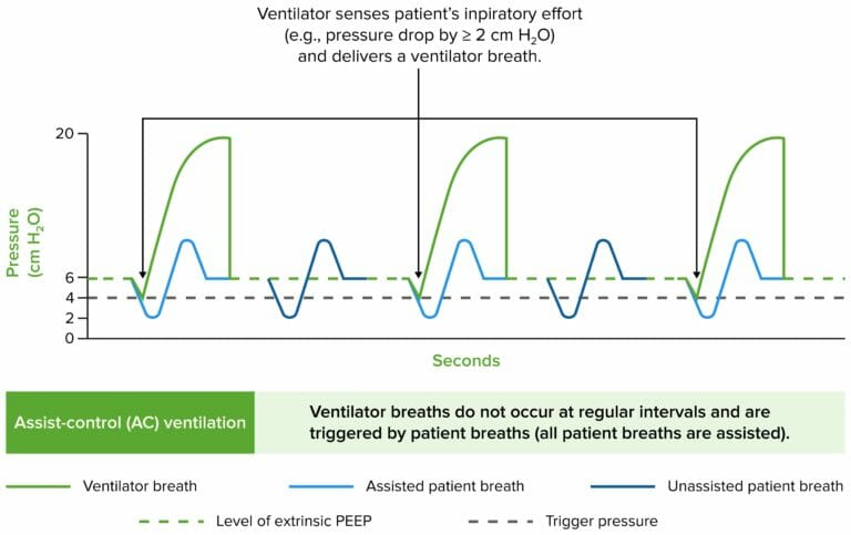 Invasive Mechanical Ventilation | Concise Medical Knowledge