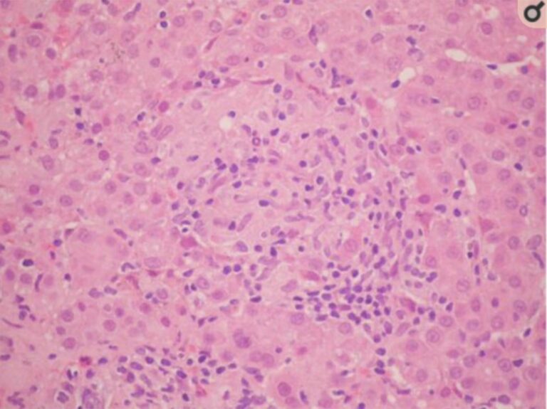 Lesão Hepática Induzida por Fármacos | Concise Medical Knowledge