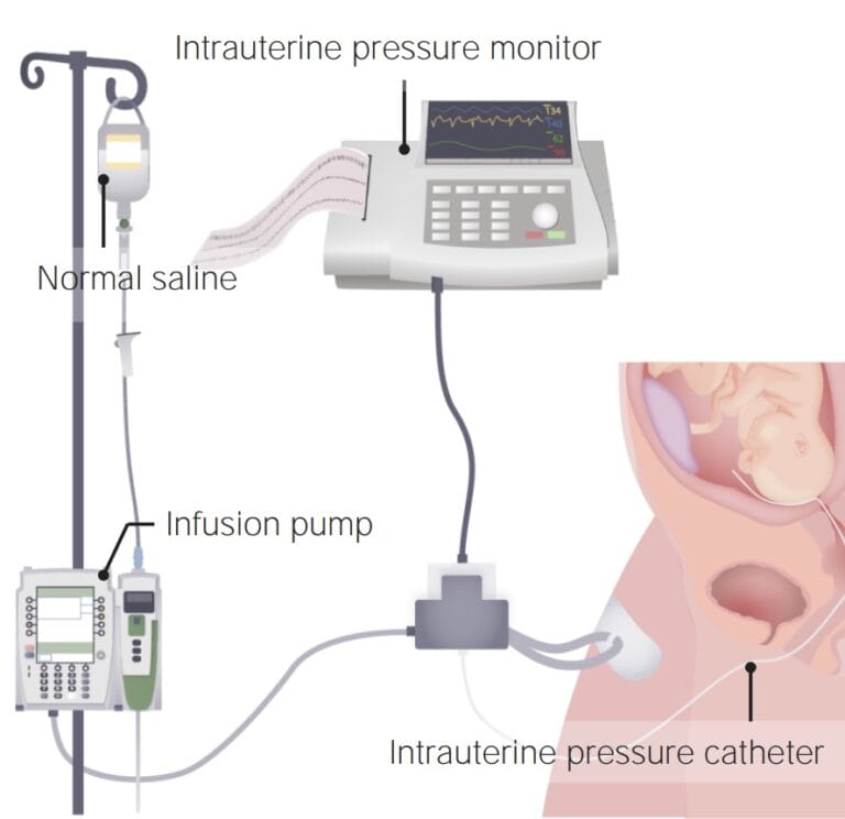 Amnioinfusion [+ Free Cheat Sheet] | Lecturio Nursing
