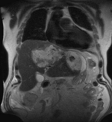 Entamoeba spp./Amebiasis | Concise Medical Knowledge