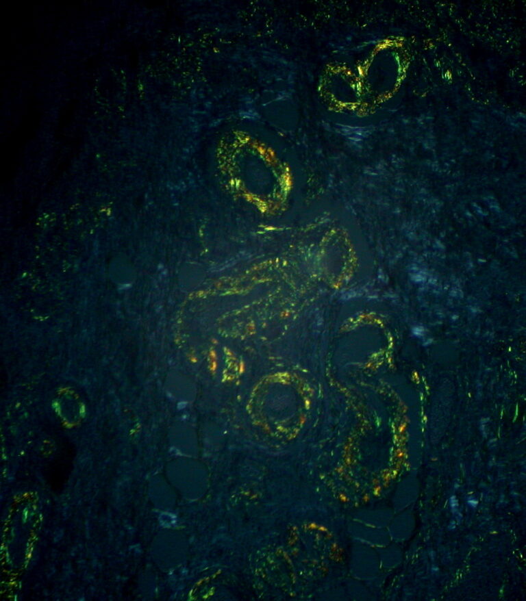 Amyloidosis | Concise Medical Knowledge