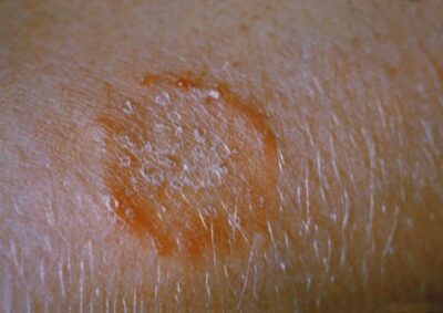 Generalized and Localized Rashes | Concise Medical Knowledge
