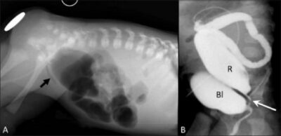 Atresia Anorretal | Concise Medical Knowledge