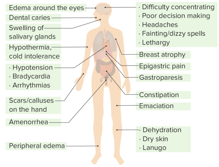 Anorexia Nervosa | Concise Medical Knowledge Anorexia Nervosa | Concise Medical Knowledge