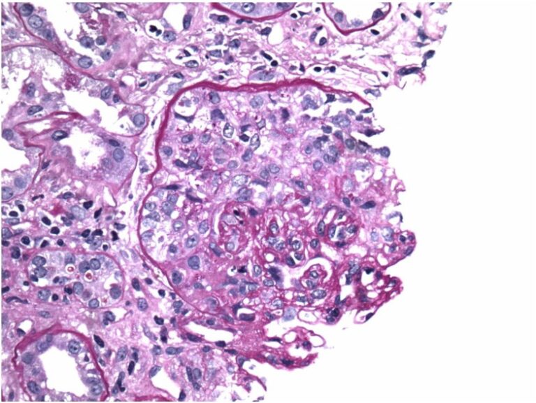 Glomerulonefrite Rapidamente Progressiva | Concise Medical Knowledge