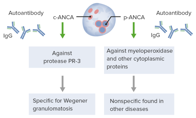 Vasculites Associadas ao Anticorpo Citoplasmático Antineutrófilo (ANCA ...