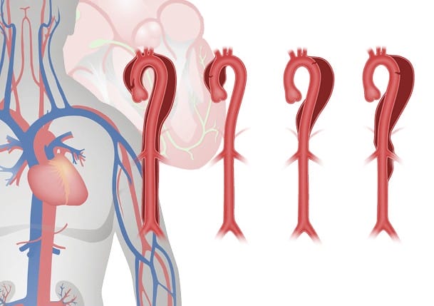 Aortic Dissection Wikipedia The Free Encyclopedia