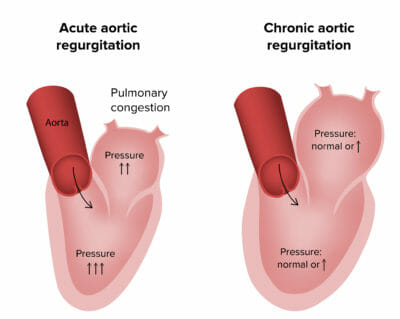 Aortic Regurgitation | Concise Medical Knowledge