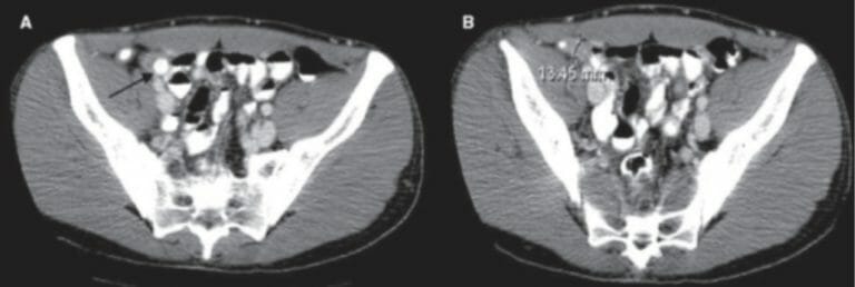 Imaging of the Intestines | Concise Medical Knowledge