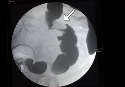 Large Bowel Obstruction | Concise Medical Knowledge