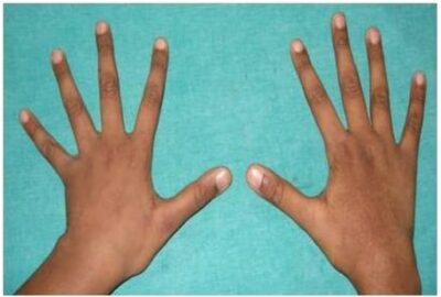 Marfan Syndrome | Concise Medical Knowledge