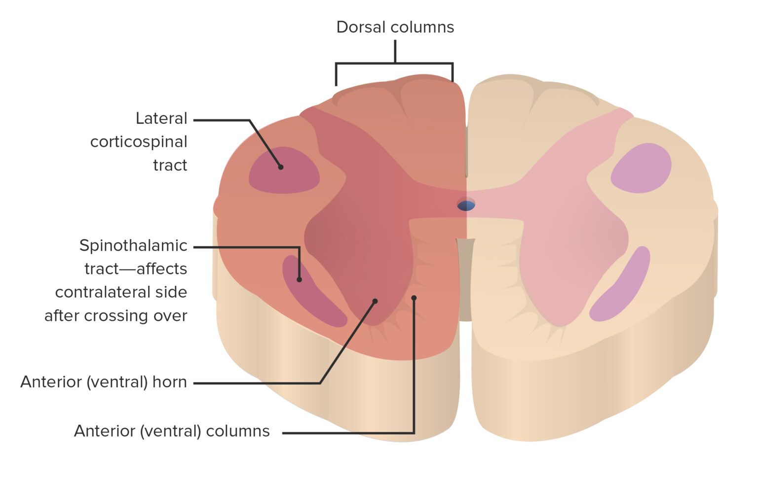 Brown-Séquard Syndrome | Concise Medical Knowledge