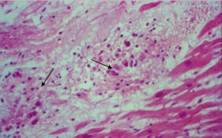 Rheumatic Fever | Concise Medical Knowledge