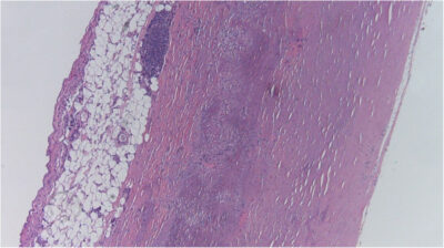 Atherosclerosis | Concise Medical Knowledge