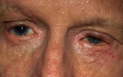 Conjunctivitis | Concise Medical Knowledge