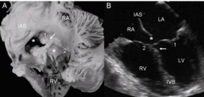 Atrioventricular Septal Defect (AVSD) | Concise Medical Knowledge