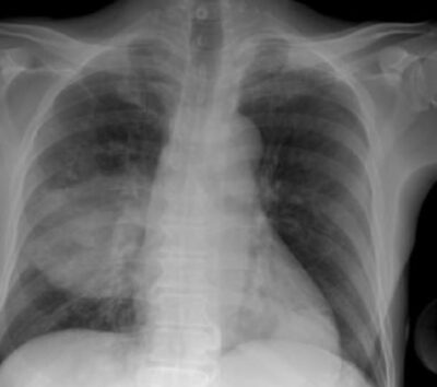 Burkholderia | Concise Medical Knowledge