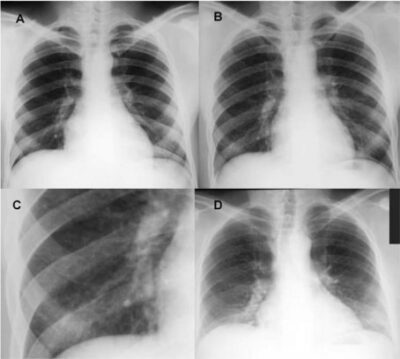 Pneumoconiose | Concise Medical Knowledge