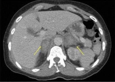 Adrenal Insufficiency and Addison Disease (Clinical) | Concise Medical ...