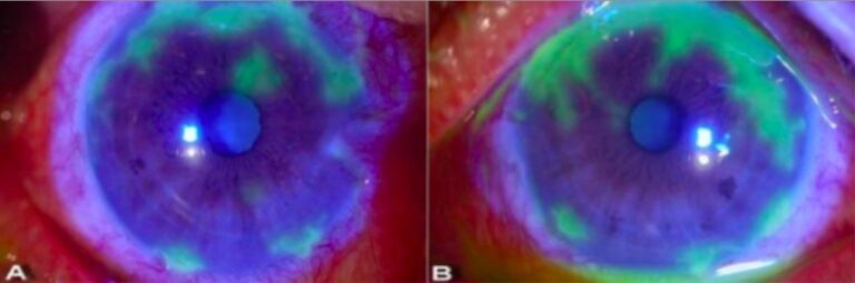 Herpes Simplex Virus 1 and 2 | Concise Medical Knowledge