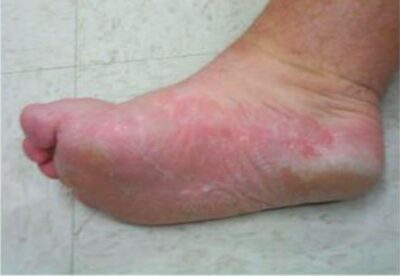 Dermatophytes/Tinea Infections | Concise Medical Knowledge