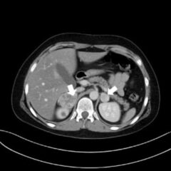 Feocromocitoma | Concise Medical Knowledge
