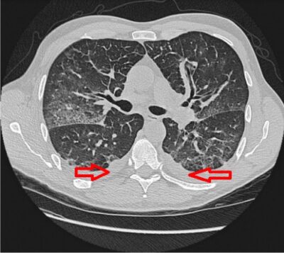 Imaging of the Lungs and Pleura | Concise Medical Knowledge