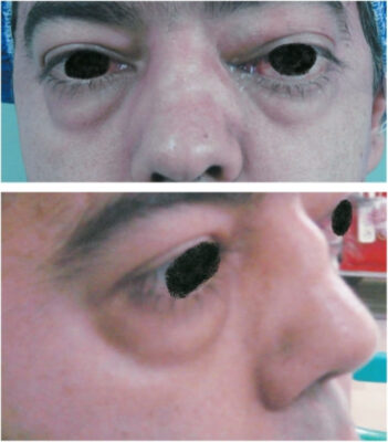 Granulomatosis con Poliangeitis | Concise Medical Knowledge