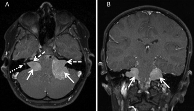 Neurofibromatosis Tipo 2 Concise Medical Knowledge