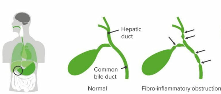 Cholestasis in Neonates and Young Infants | Concise Medical Knowledge