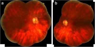 Chorioretinitis | Concise Medical Knowledge