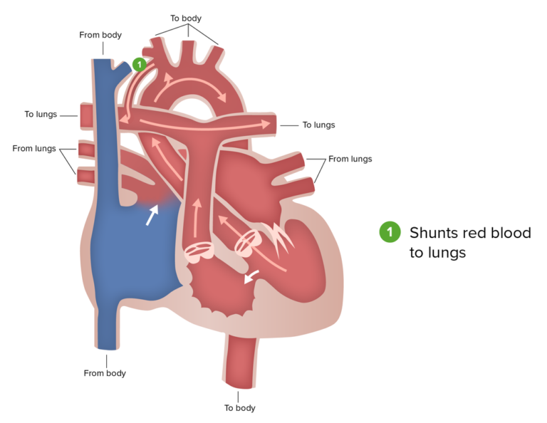 Atresia da Válvula Tricúspide (AVT) | Concise Medical Knowledge