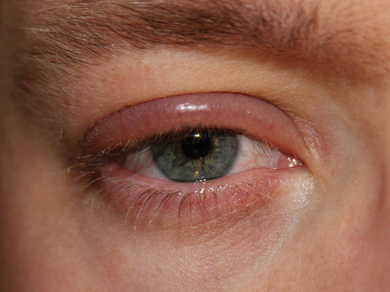 Blepharitis (Clinical) | Concise Medical Knowledge